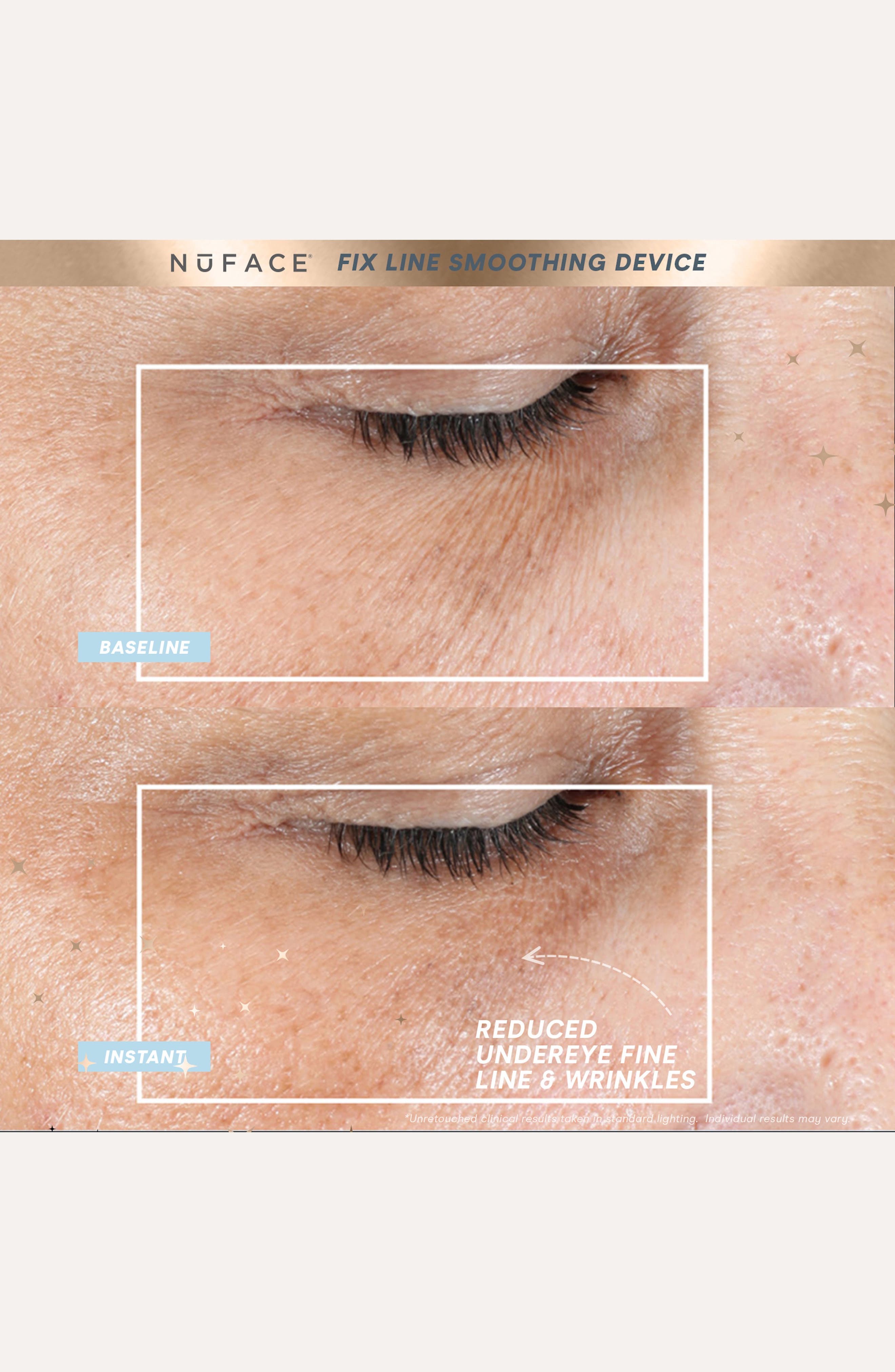 NuFACE® FIX® Line Smoothing Regimen Set USD $208 Value | Smart Closet