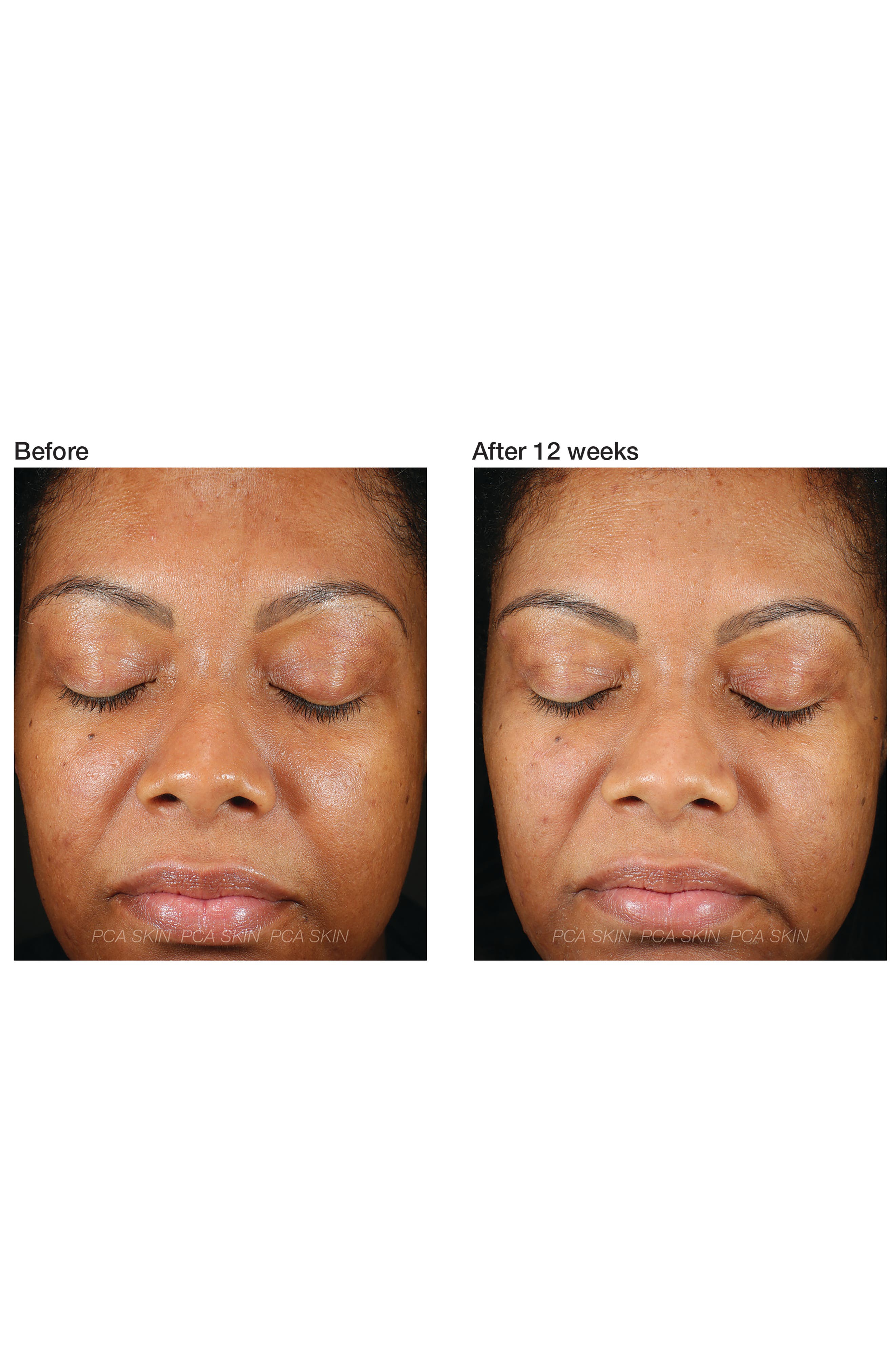PCA Skin C&E Advanced with Hexylresorcinol and Silymarin Treatment ...