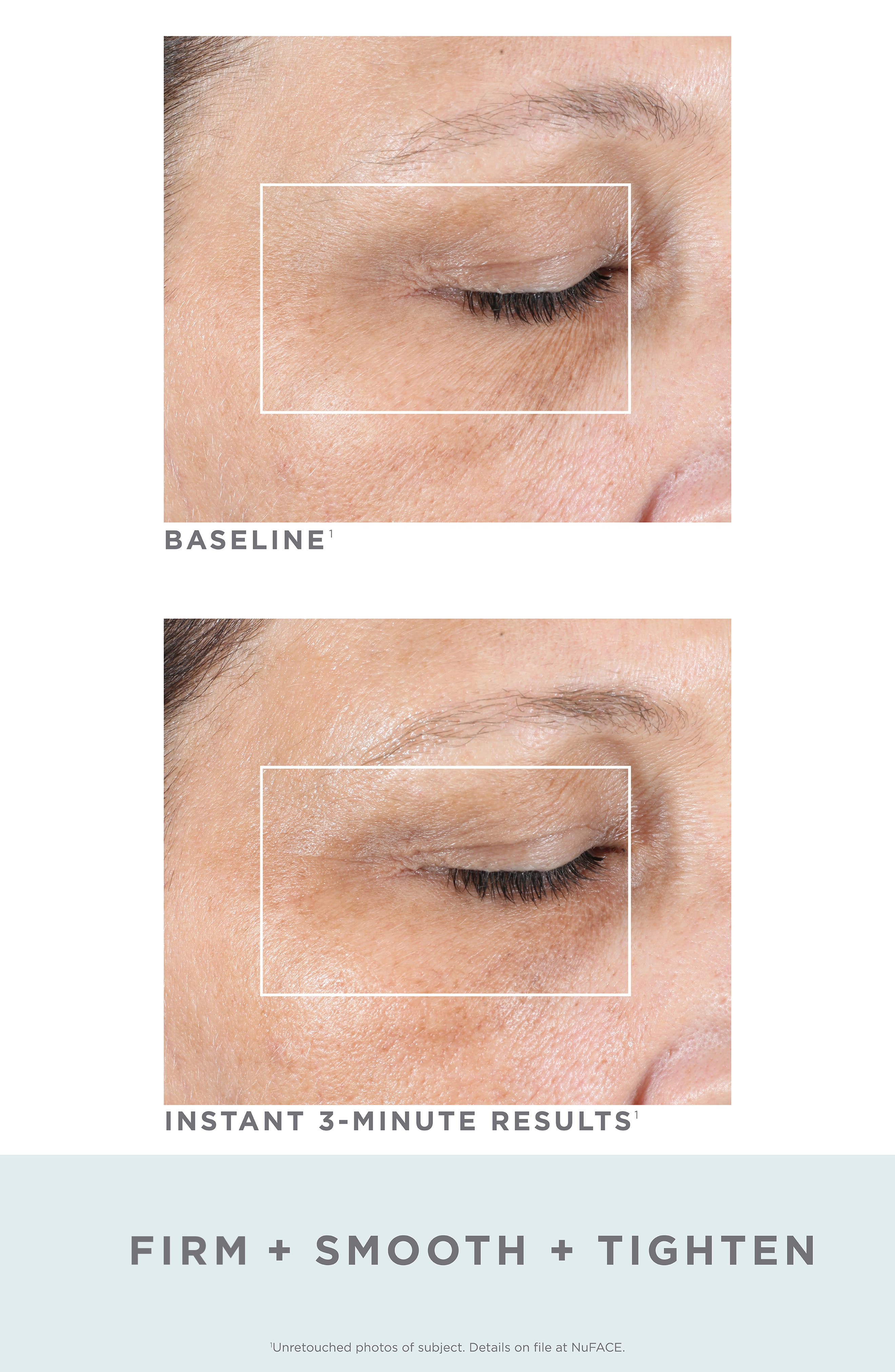 NuFACE® FIX Line Smoothing Device Kit | Nordstrom