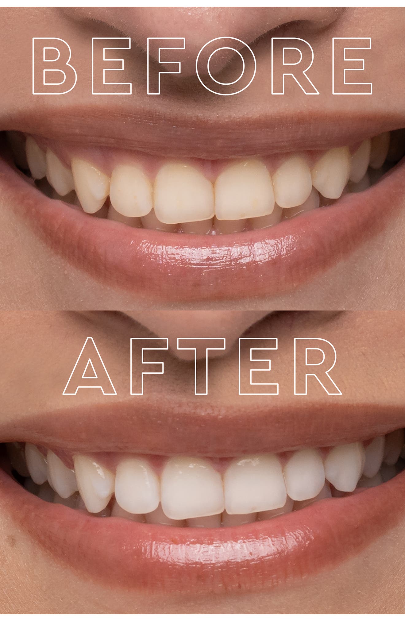 MOON The Teeth Whitening Device System | Nordstrom