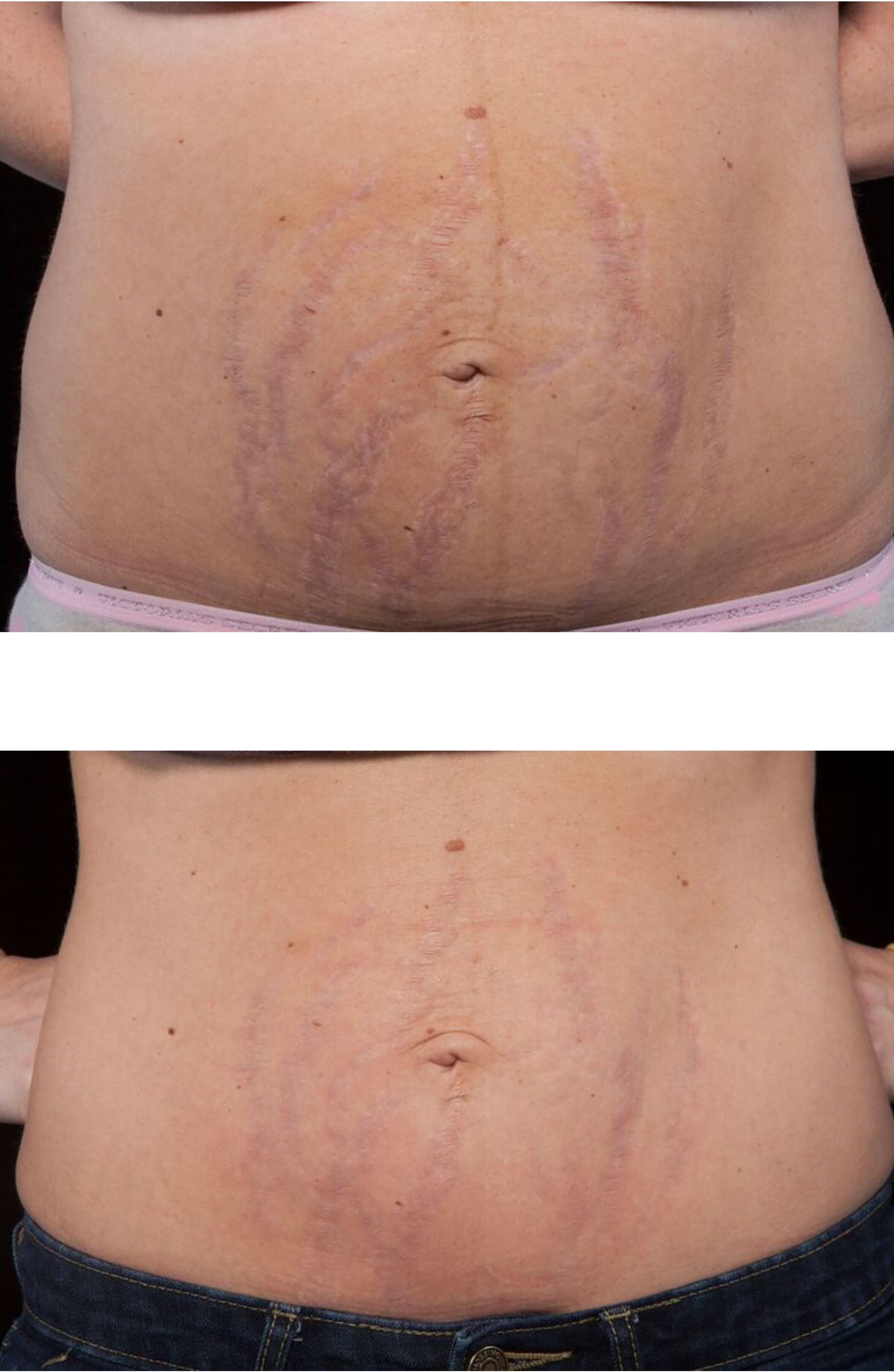 Strialite Stretch Mark LED Treatment Device | Nordstrom