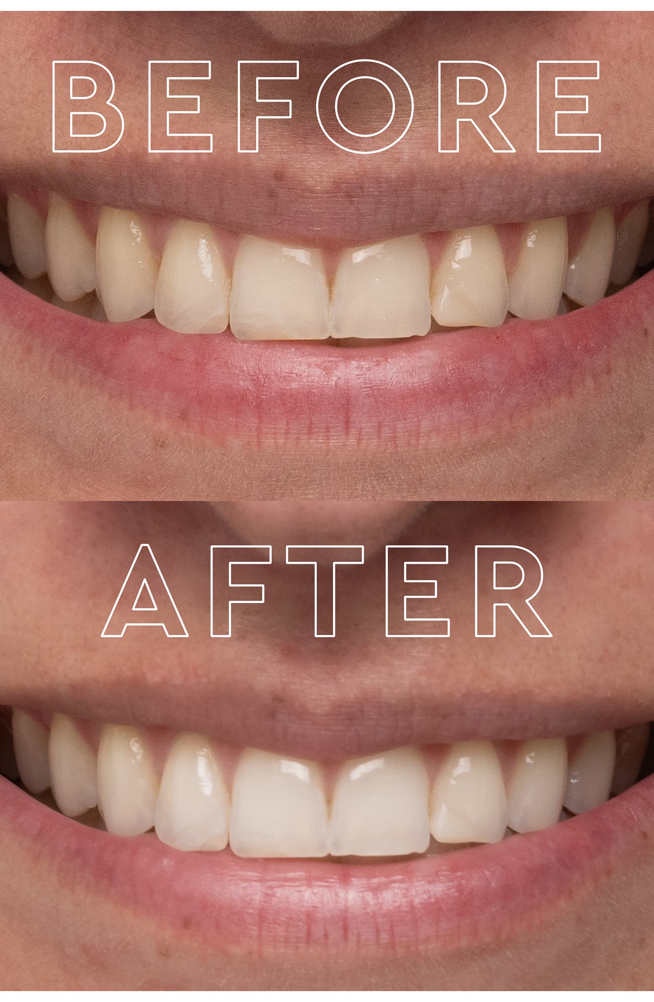 MOON The Teeth Whitening Device System | Nordstrom