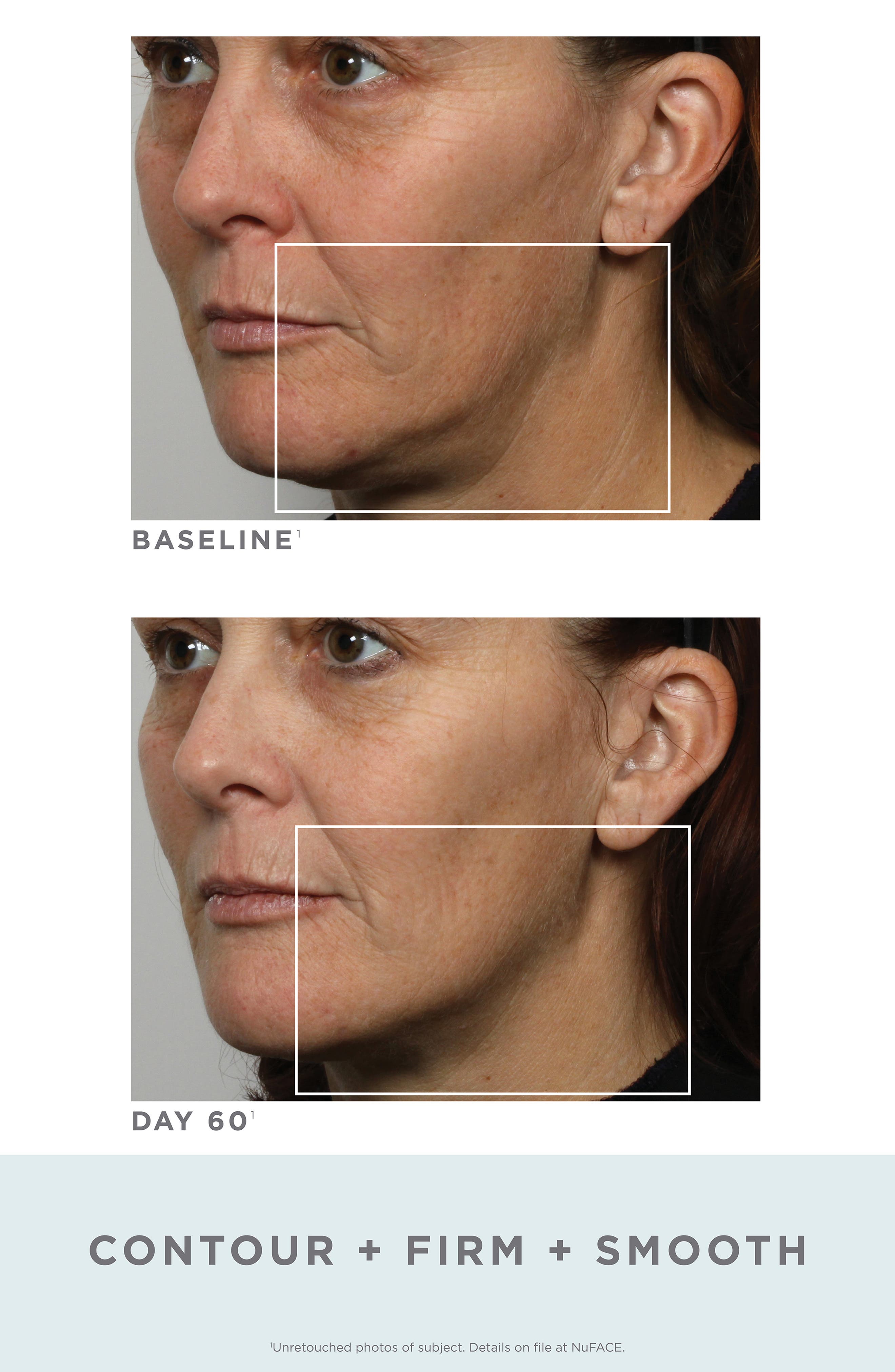 NuFACE® Trinity® Facial Toning Kit $339 Value | Nordstrom