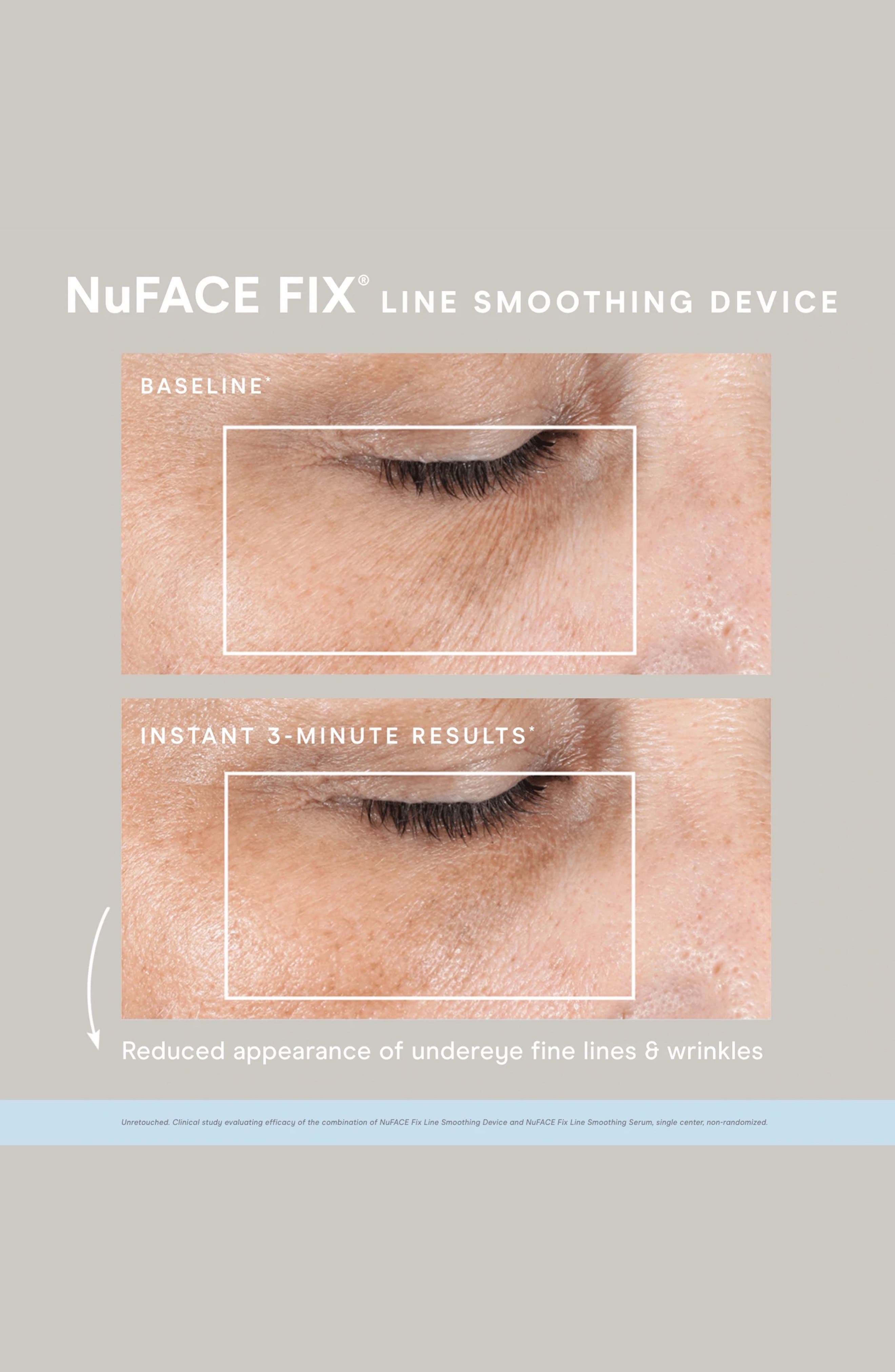 NuFACE® FIX Line Smoothing Device & Serum Set $165 Value | Nordstrom