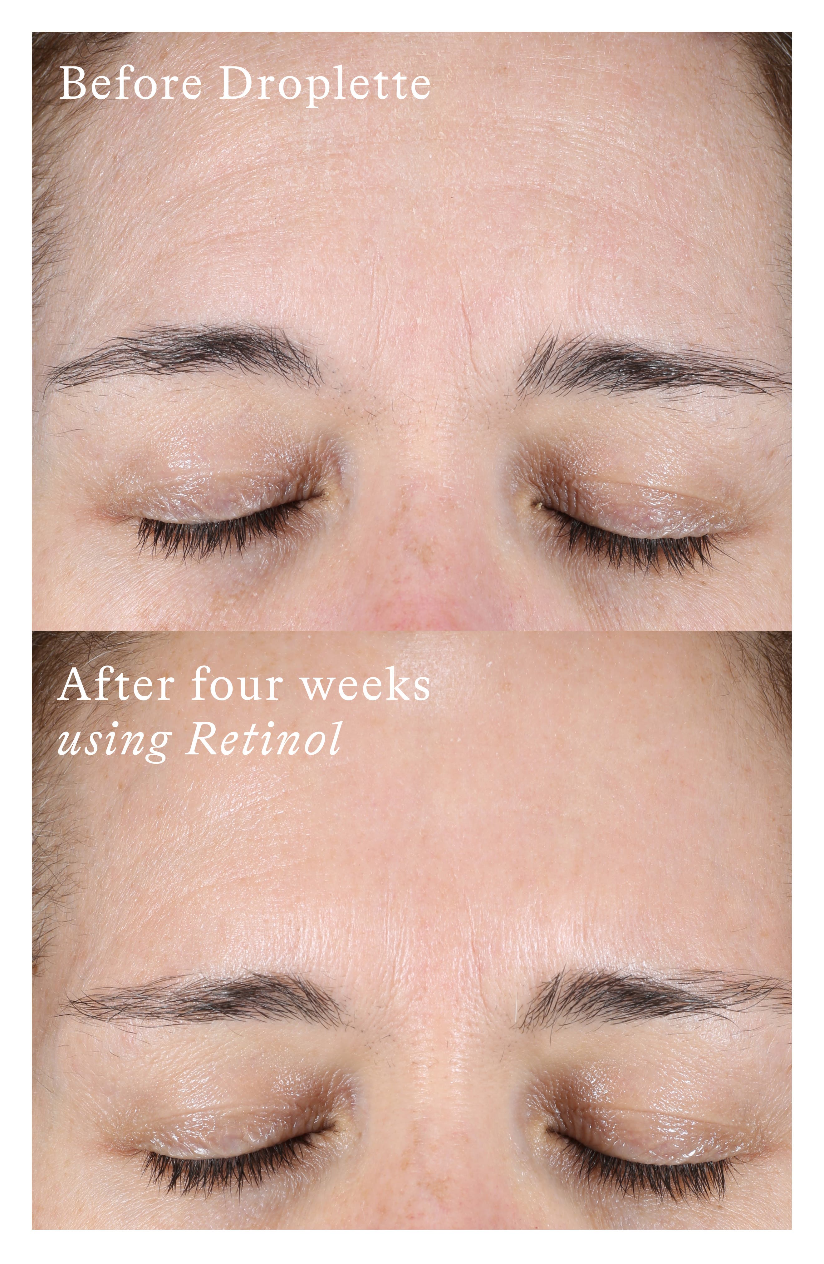 Droplette Microinfusion Device | Nordstrom