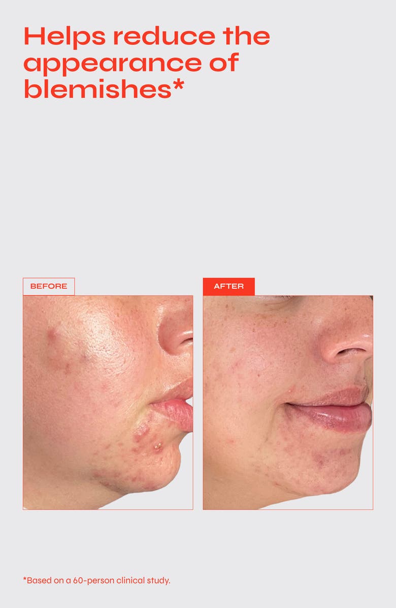 FACILE Clear Exfoliating Serum for Blemishes with 10% AHA + BHA Blend ...