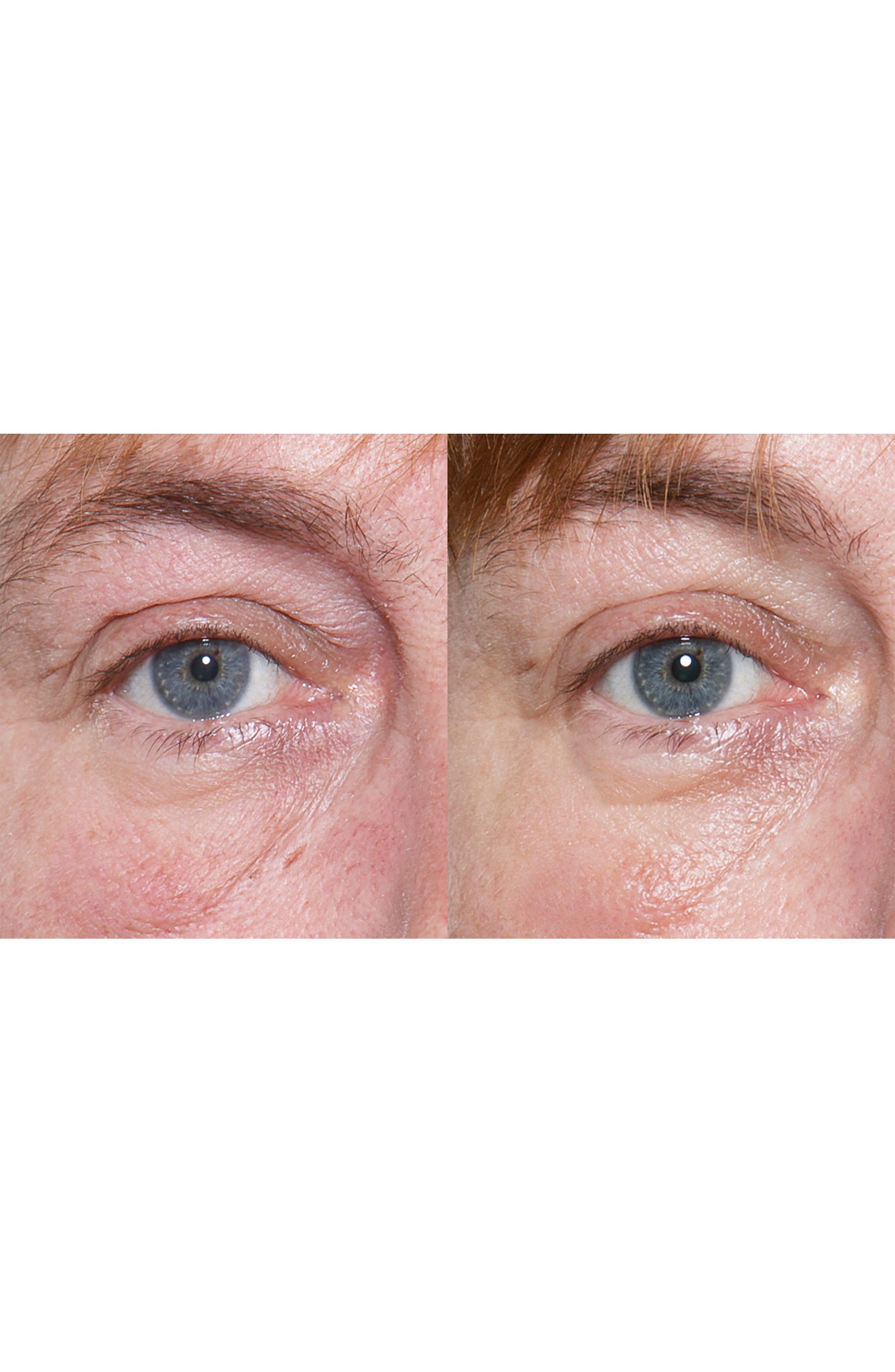 Silk'n ReVit™ Microdermabrasion Device | Nordstrom